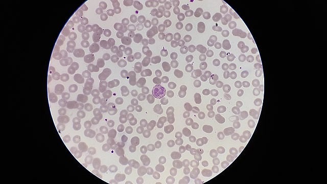 Platelets the Key to Understanding Kawasaki Disease