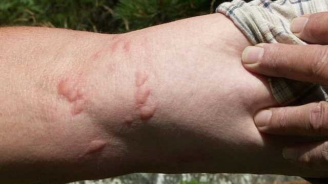 Fire Ant Allergy: Overcoming the Challenges of Venom Immunotherapy