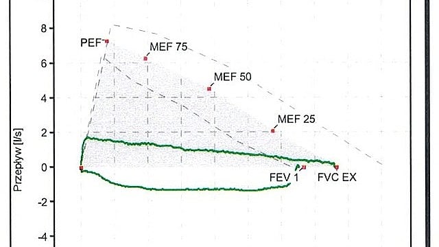 Impacts of the Removal of Race-Correction in Lung Pulmonary Function ...