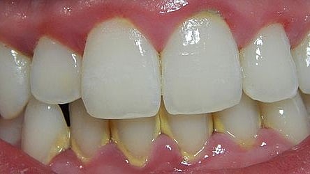 New At-home Test for Gingivitis Protects Oral Health