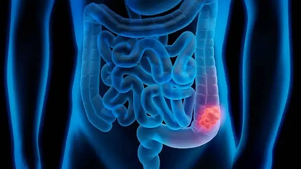 Study Reveals Colon Tumor Location Matters for Metastatic Disease