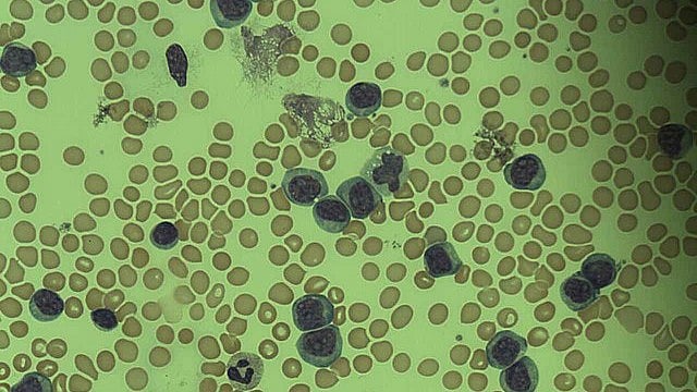 India's First Pediatric Chemotherapy Syrup: PREVALL Revolutionizes ALL ...