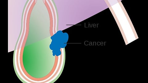 Doctors of KGMU Find a New Method to Diagnose Gallbladder Cancer