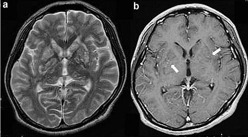 Better Diagnosis and Treatment of Cryptococcosis.