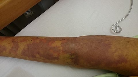 Texas Man Recovers from Sepsis Caused by Rare Bacteria