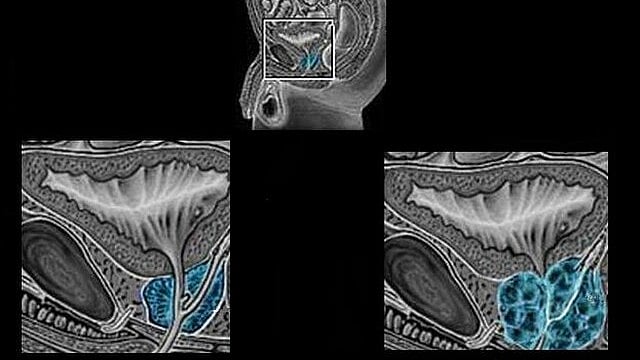New Prostate Cancer Report Card Keeps Treatment Options Simple to ...
