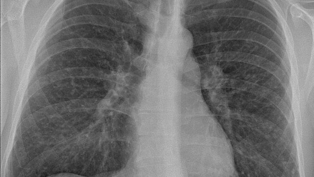 Mumbai's Doctors Perform AICD Implantation to Treat Rare Heart Disease