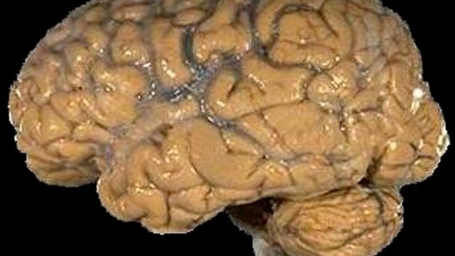 Neural Prosthetic Device Can Help Humans Restore Memory