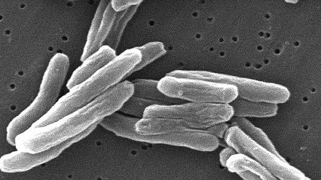 New Tuberculosis Test Could Improve TB Care Globally