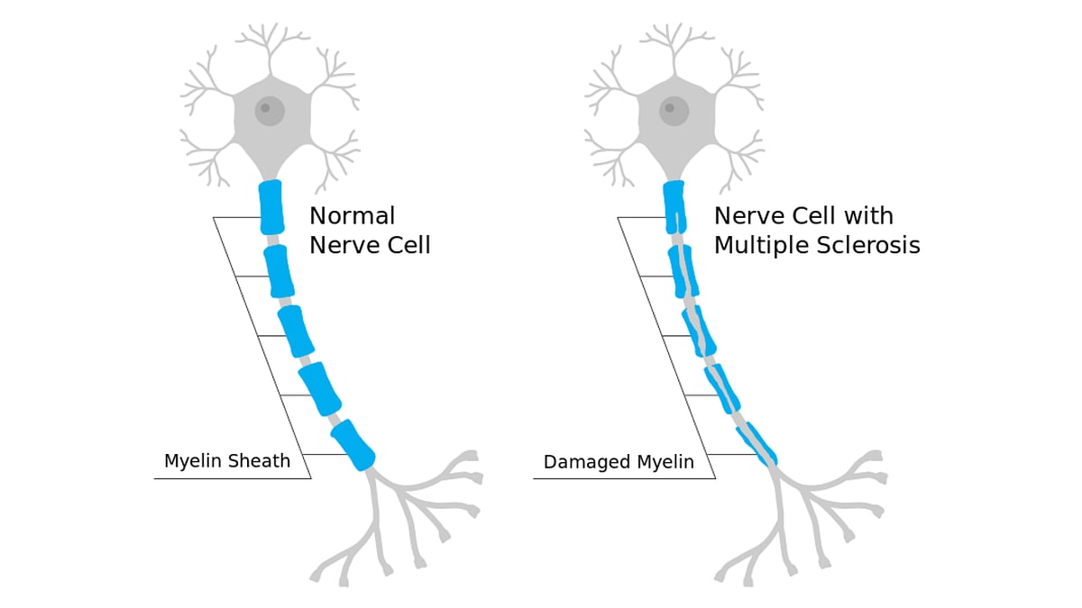 Understanding Multiple Sclerosis: A Comprehensive Overview | Symptoms ...