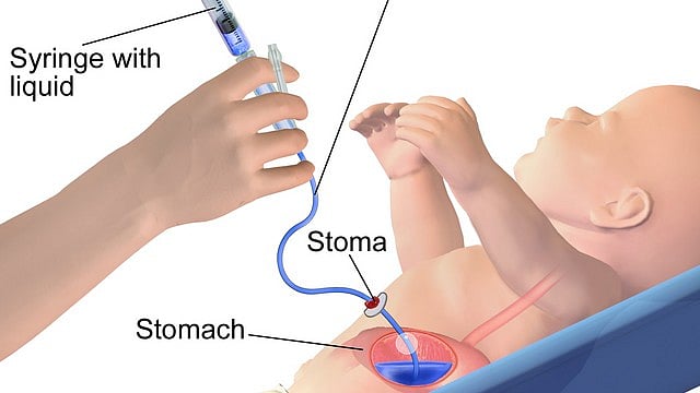 Tube-eeze Patches Revolutionize Accessibility for Babies with Medical ...