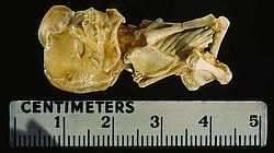 Woman Dies After Surgery to Remove Rare 'Stone Baby' or "Lithopedion"