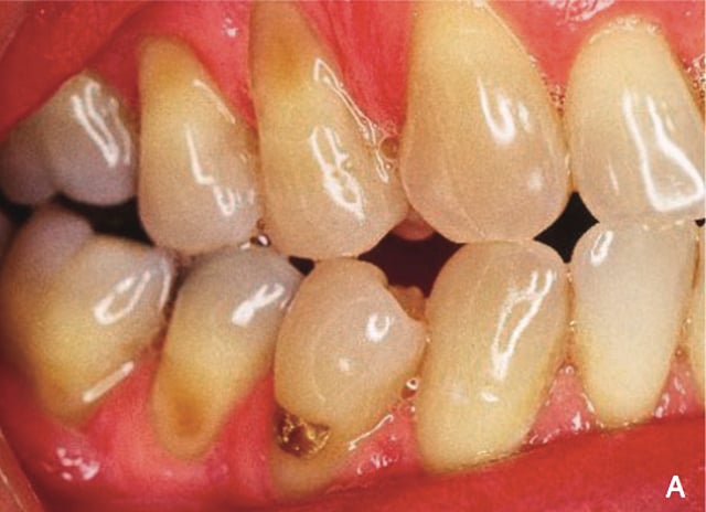 When Brushing Goes Wrong: The Damage Caused by Overbrushing