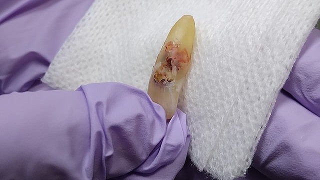 Tooth Resorption: Causes, Symptoms, and Treatment Options