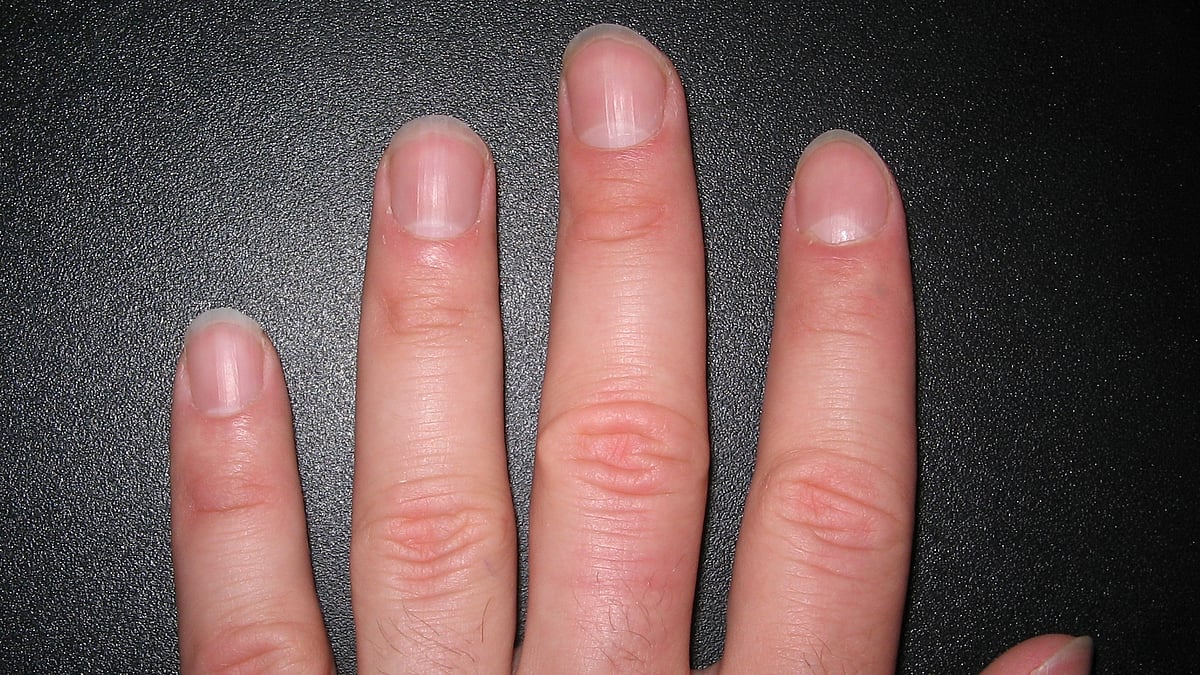 5 Reasons Why Your Nails Show White Lines or Spots?