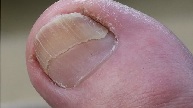 5 Reasons Why Your Nails Show White Lines or Spots?