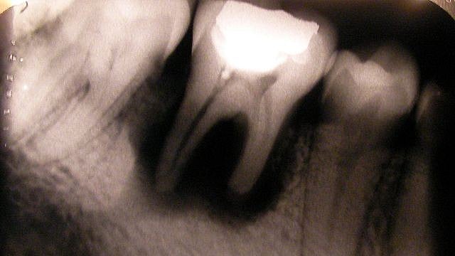 Tooth Resorption: Causes, Symptoms, and Treatment Options