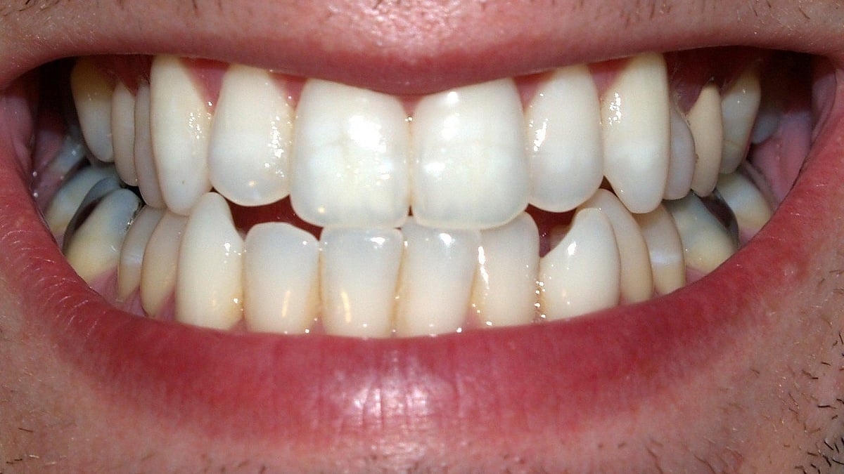 Yellow Alert: Avoid These Common Tooth-Tinting Mistakes!