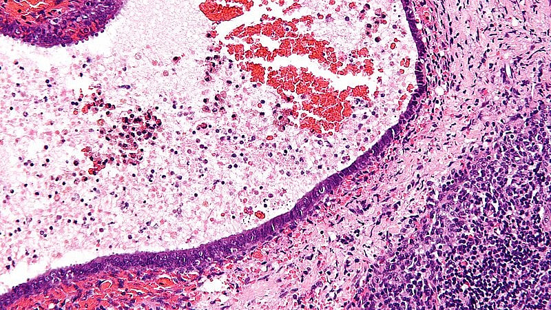 Specialist Scanning Needed to Help Endo Patients