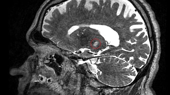 Diagnosis of Essential Tremor: Family Risk Insights