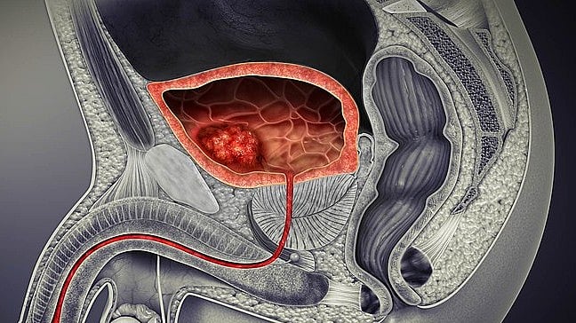 Advancing Bladder Health: Innovation in Bladder Augmentation and Monitoring