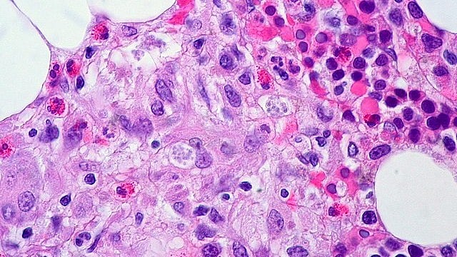 First Case of Sexually Transmitted Fungal Infection Find in New York City