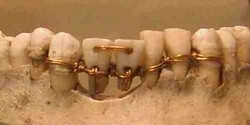 Tooth Worms: Myth or Reality? Unveiling the History of Dental Folklore ...