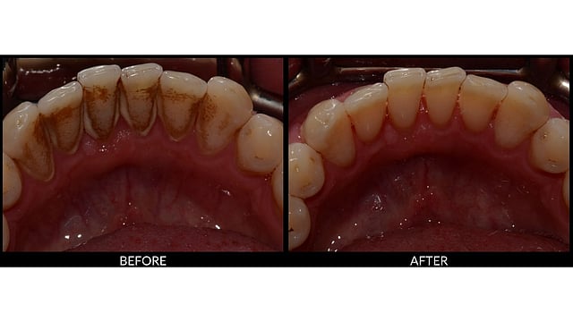 Everything You Need to Know About Teeth Scaling: A Dentist’s Perspective