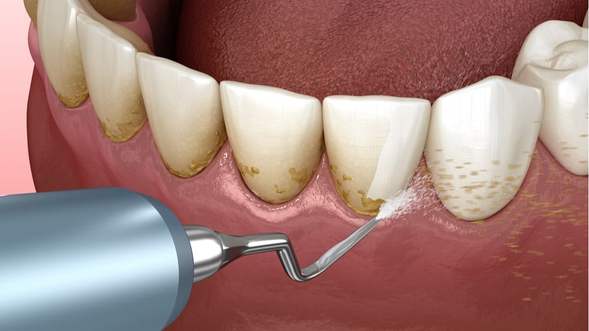 Everything You Need to Know About Teeth Scaling: A Dentist’s Perspective
