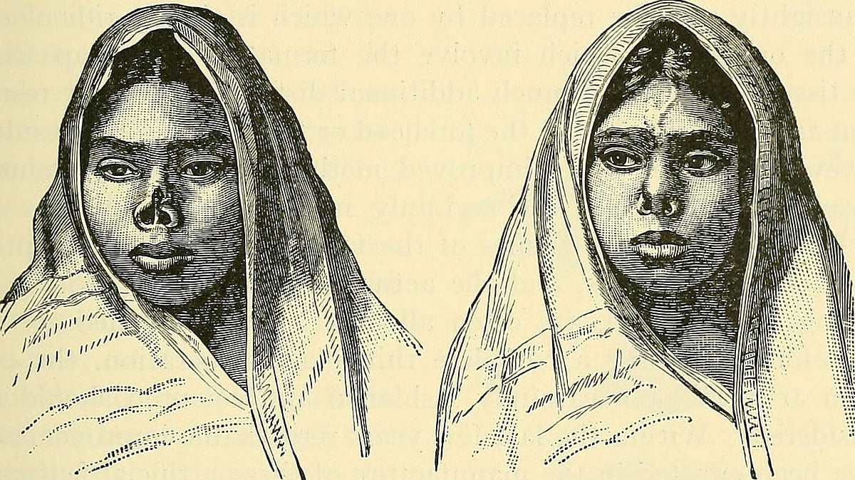 History of Plastic surgery In 600 BC