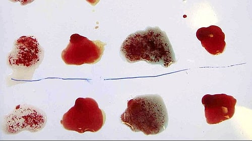 Blood Mystery Solved: The Discovery of AnWj Blood Group System