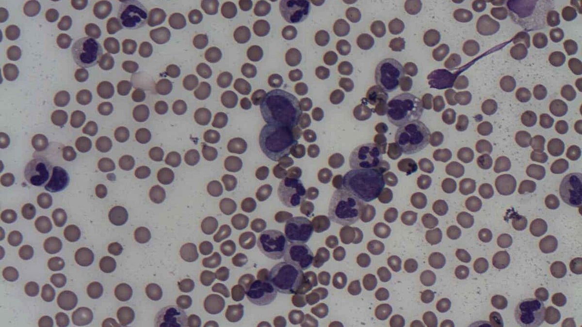 Triple Regimen Brings Hope to Advanced Chronic Myeloid Leukemia Patients