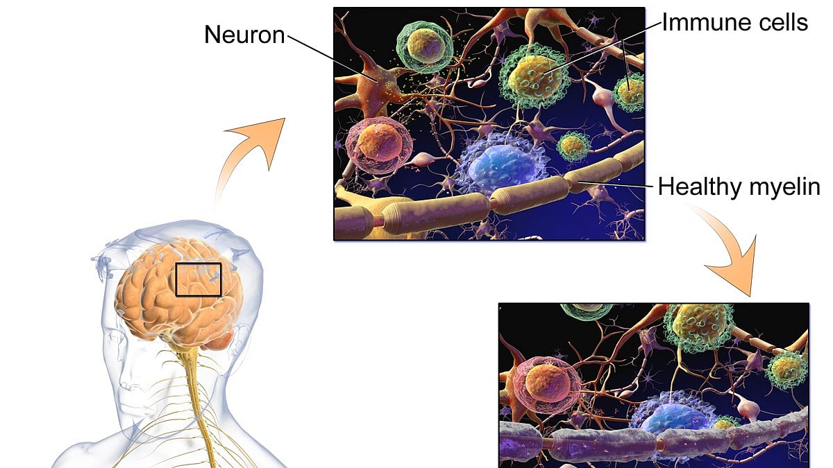 ACTRIMS Outlines Guidance for Diagnosing Pediatric and Late Onset ...