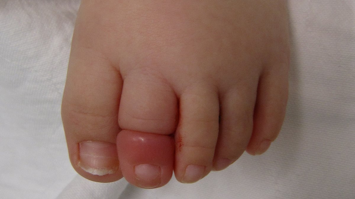 Can a Single Hair Strand Lead to Amputation of Baby’s Toe?