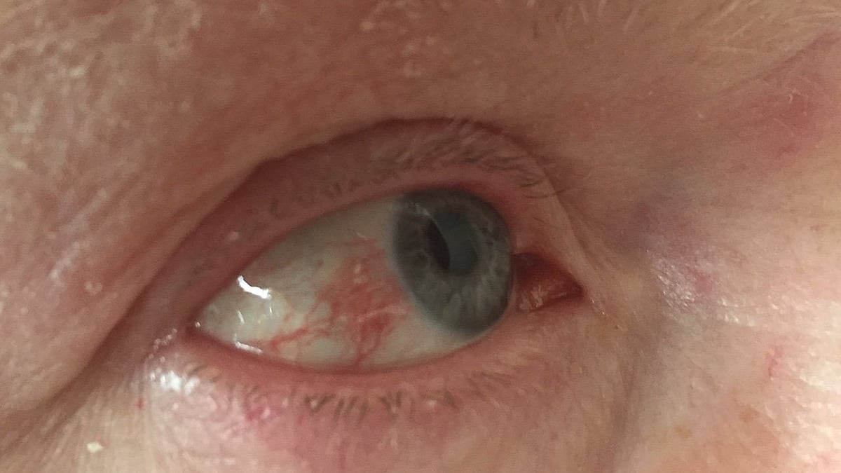 Valacyclovir Reduces Eye Disease and Pain in Shingles Patients