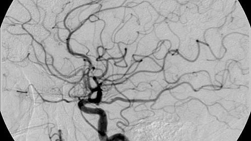 What is a Wada Test? CHLA’s Dr. Sucheta Joshi Tells Parents What to Expect