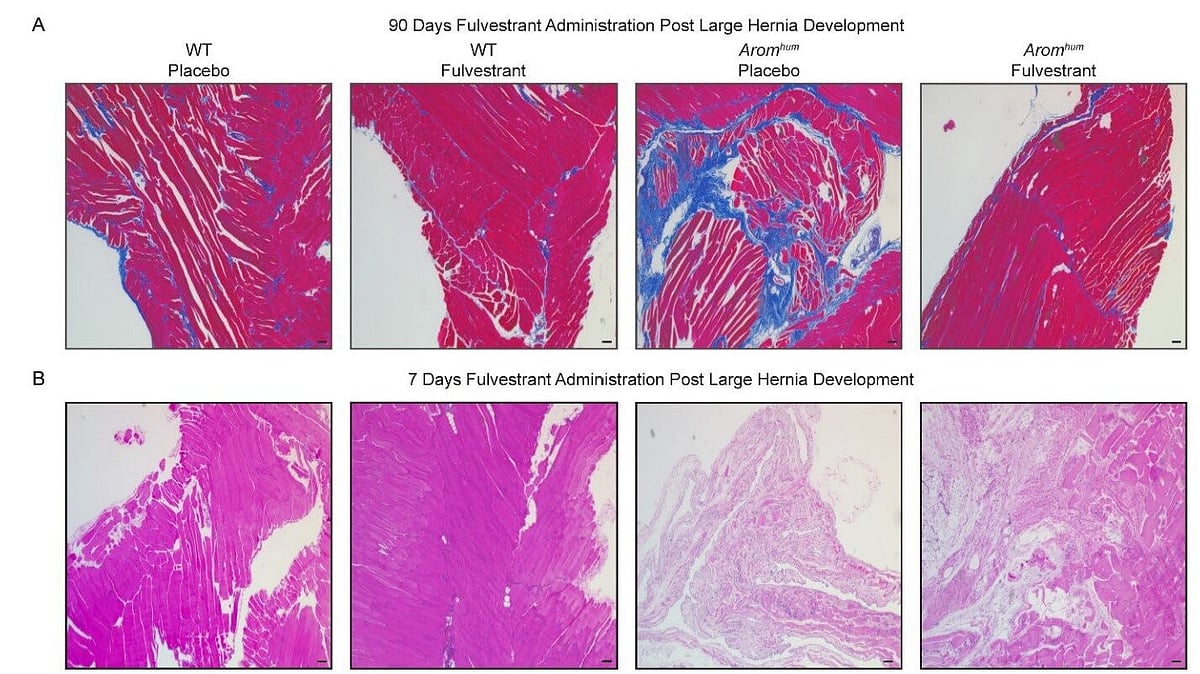 Could Inguinal Hernias Be Treated Without Surgery? New Study