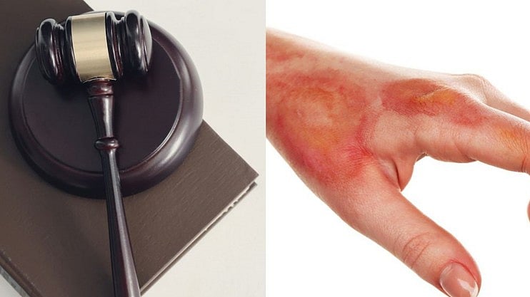 Burn Injuries: Legal Support for Life-Altering Consequences