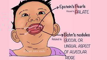 Epstein pearls and Bohn's nodules: A complete guide for parents