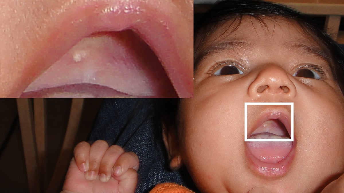 Epstein pearls and Bohn's nodules: A complete guide for parents