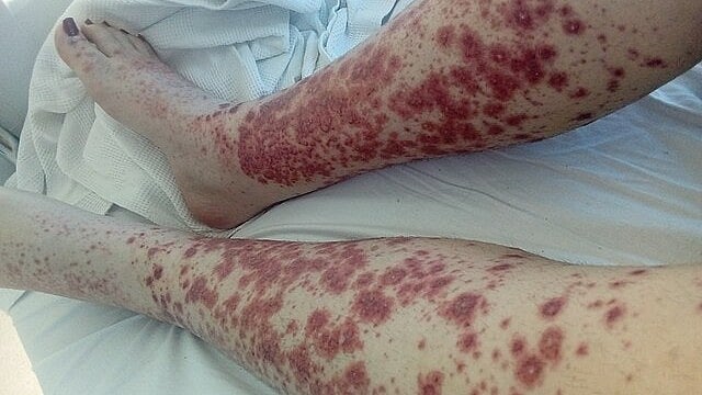 The Molecular Mechanism Behind Hydralazine-Induced ANCA Vasculitis