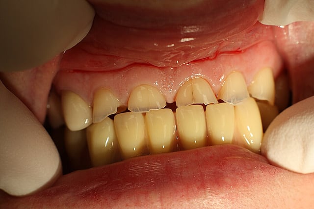 Tooth Wear:Attrition Vs Abrasion