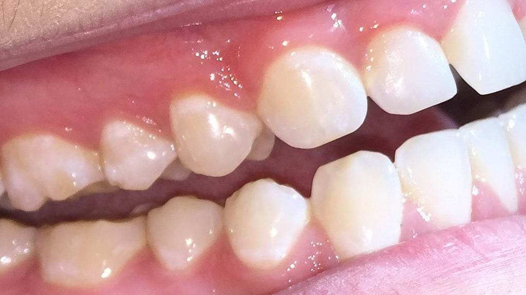 Tooth Wear:Attrition Vs Abrasion
