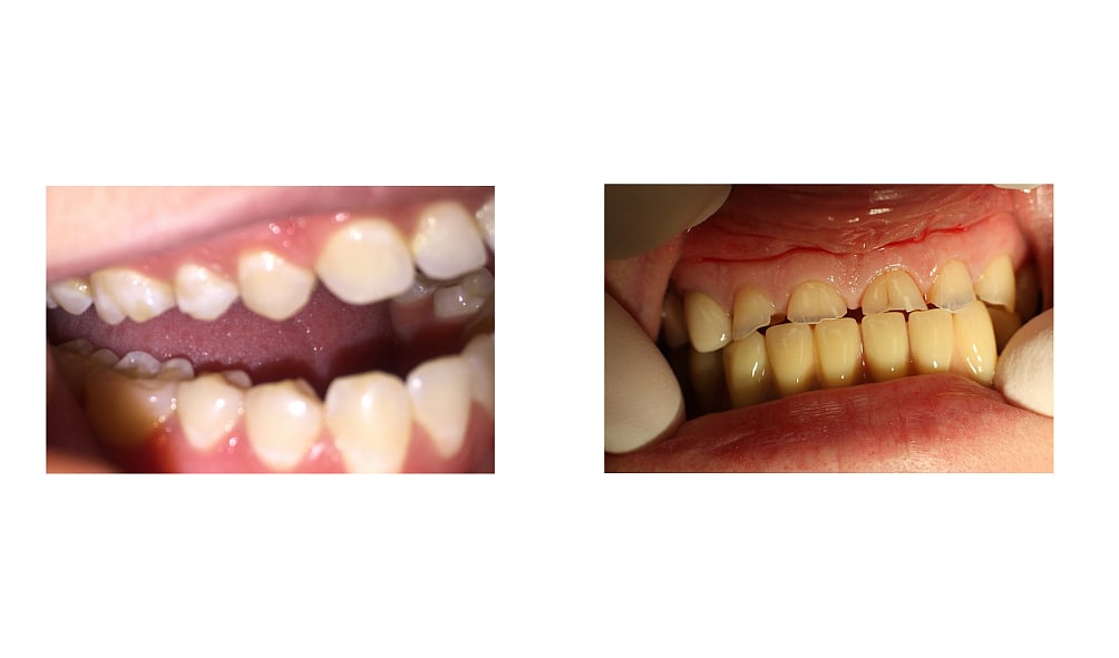 Tooth Wear:Attrition Vs Abrasion
