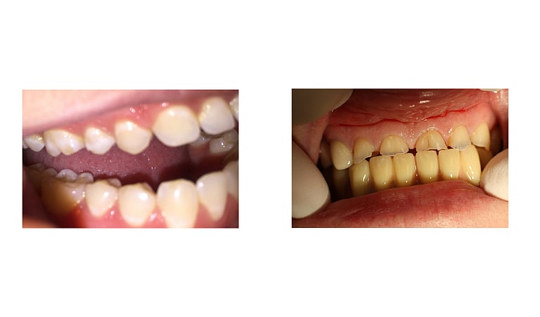 Tooth Wear:Attrition Vs Abrasion