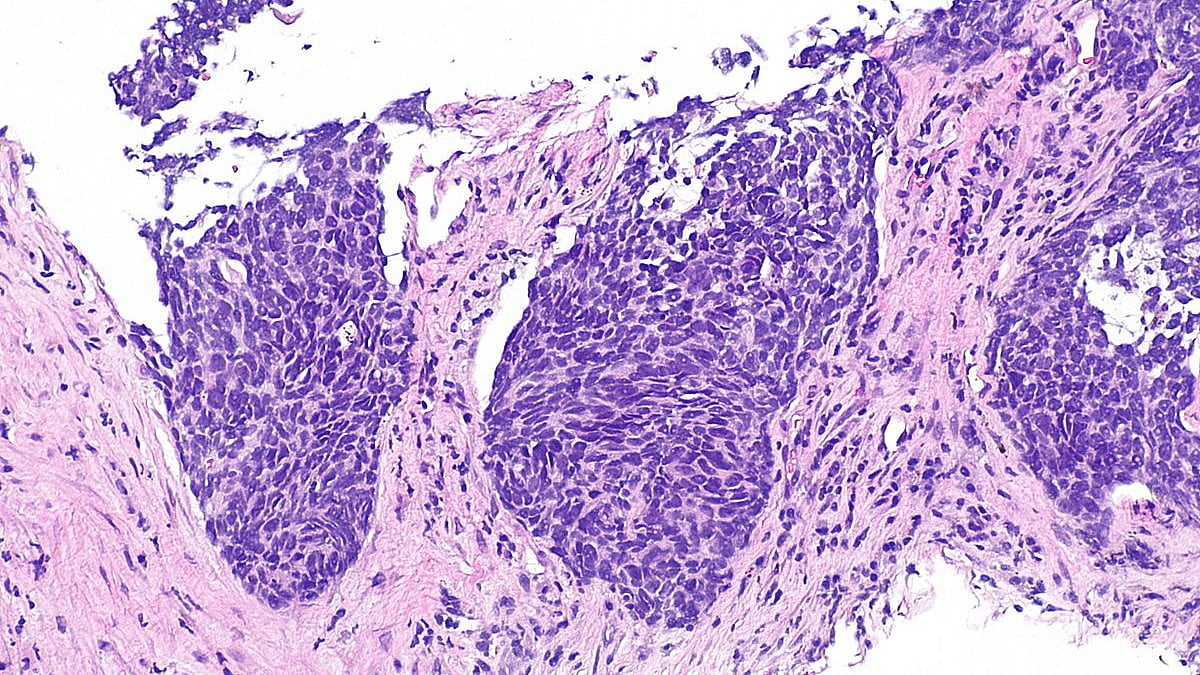 New Biomarker May Guide Best Use of KRAS Inhibitors in Lung Cancer