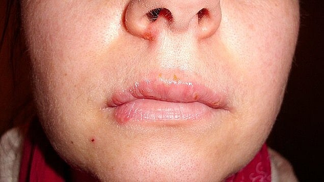 Medical Alert: Understanding Hard Lip Bumps and Treatments