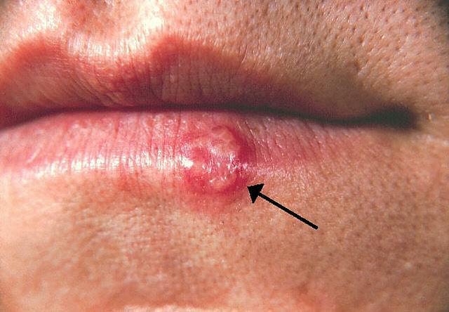 Medical Alert: Understanding Hard Lip Bumps and Treatments
