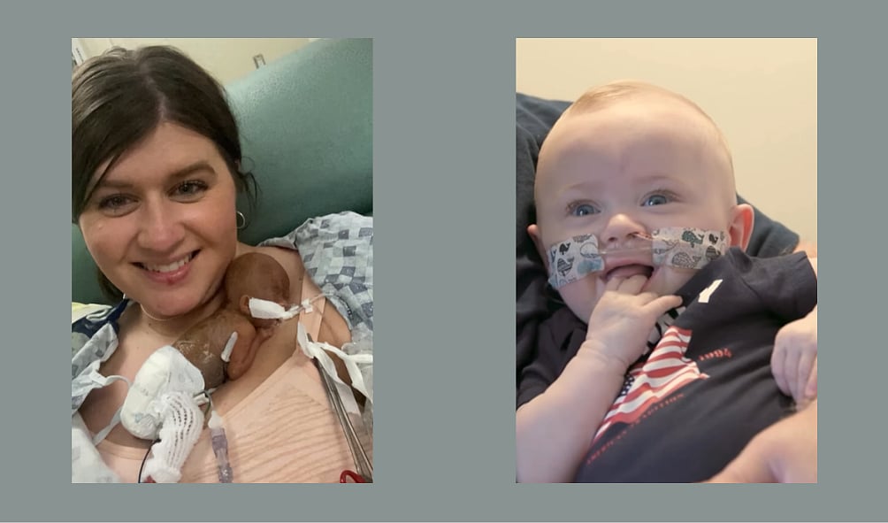 World's Most Premature Baby Nash Keen Defies Odds to Turn One