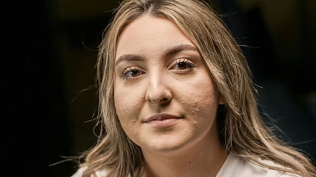 Acne Explained: A GP’s Guide to Causes, Types, and Effective Treatment